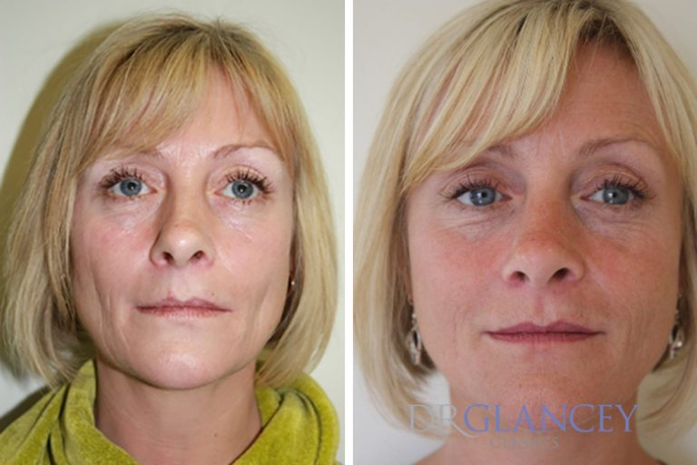 Sculptra | Dr Glancey Clinics