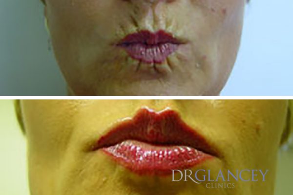 Botox | Dr Glancey Clinics