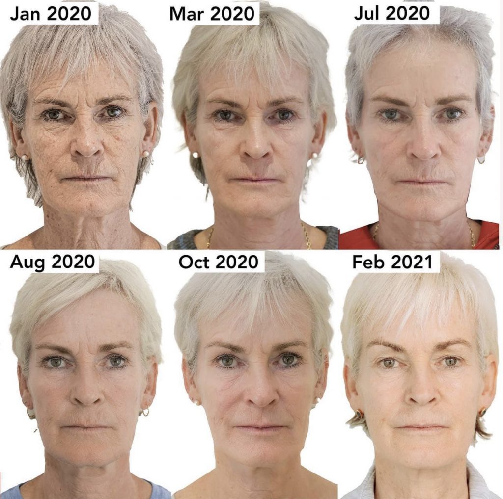 Morpheus by Inmode - Dr Glancey Clinics