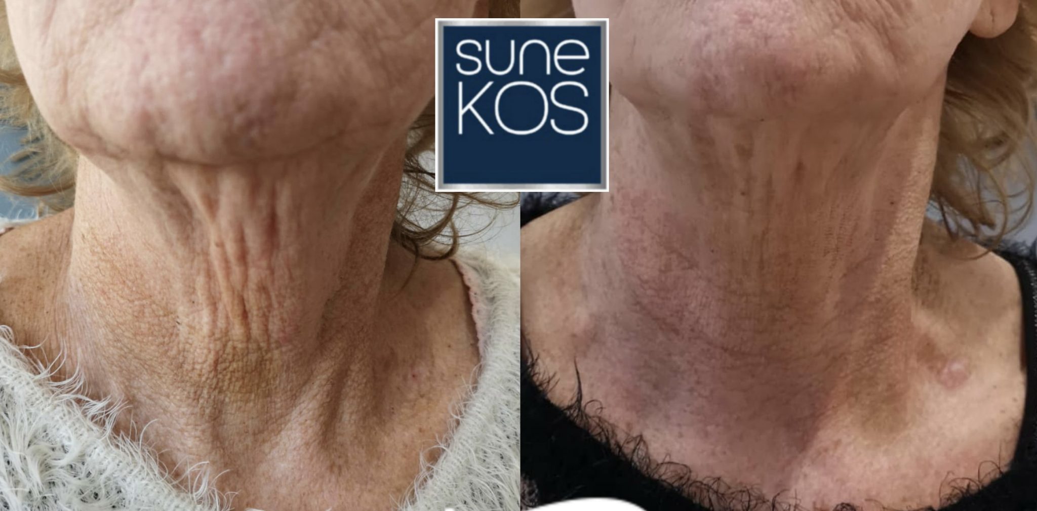 SuneKos - Dr Glancey Clinics